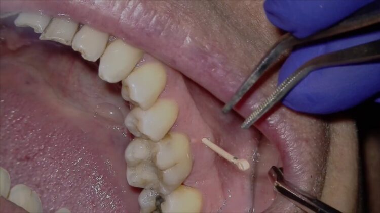 Dental Sinus Infection Symptoms Finally Revealed - Now Then Digital