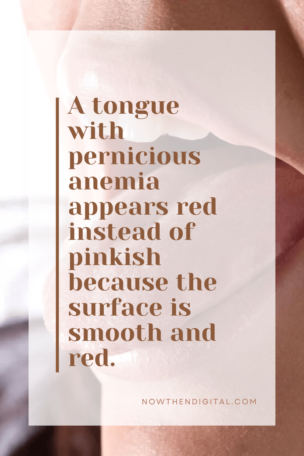 What Is Pernicious Anemia Tongue, and How Is It Treated? - Now Then Digital