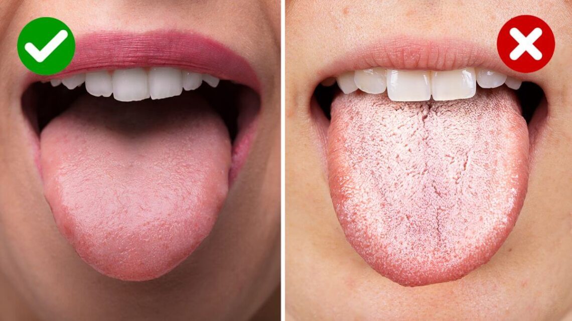 What Is Pernicious Anemia Tongue, and How Is It Treated? - Now Then Digital